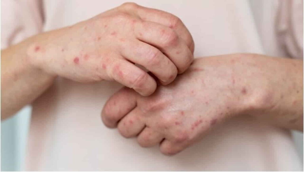 12 Provinsi KLB Penyakit Campak, Kepri Masih Minim Kasus